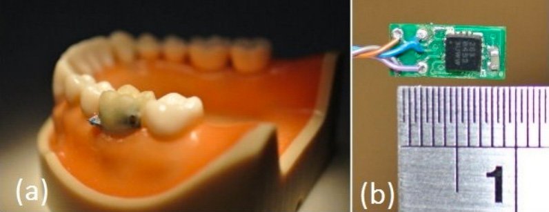 Crean un chip dental que recolecta información sobre la salud de la ...