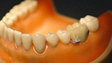 Crean un chip dental que recolecta información sobre la salud de la ...