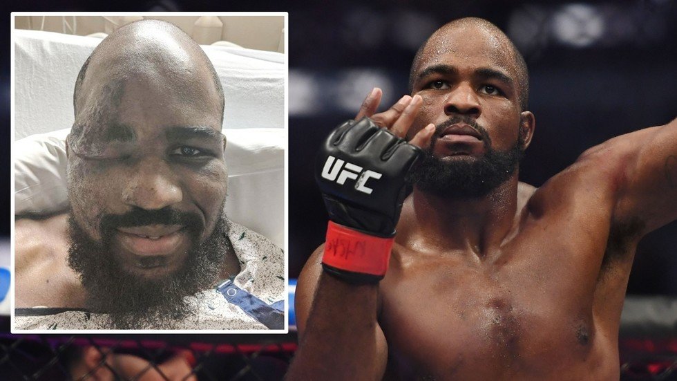 UFC star Corey Anderson displays gruesome facial injuries suffered ...