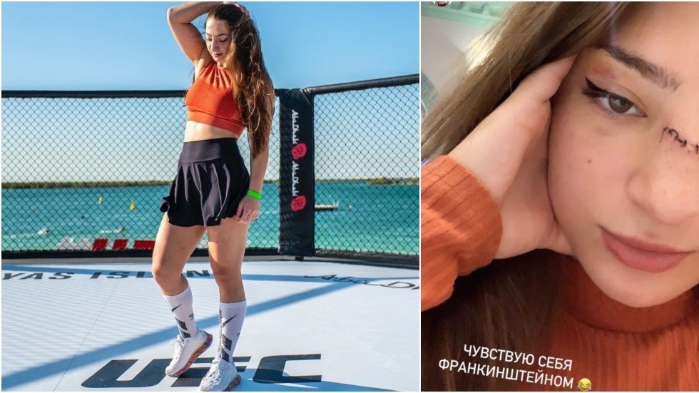 'I feel like Frankenstein': Liana Jojua shows grisly stitched-up nose ...